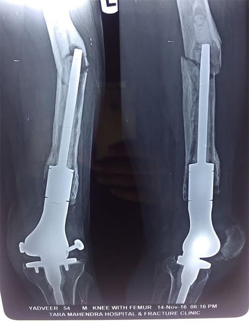 Limb Reconstruction Surgery & Treatment in Jaipur, Rajasthan